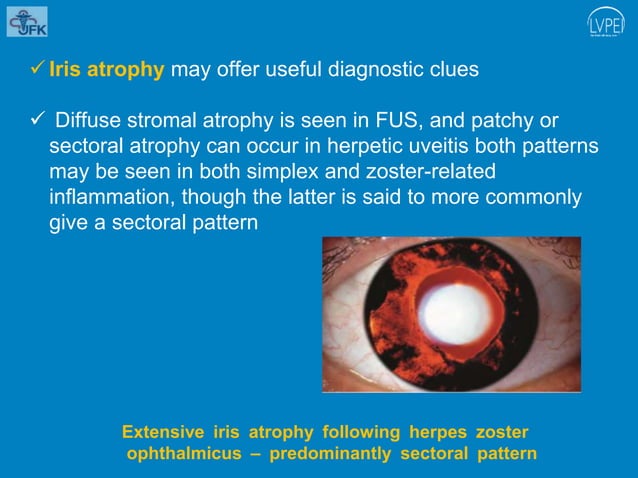 Uveitis signs and symptoms.pptx
