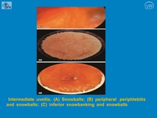 Uveitis signs and symptoms.pptx