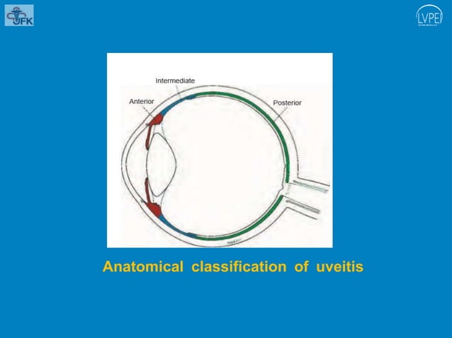 Uveitis signs and symptoms.pptx