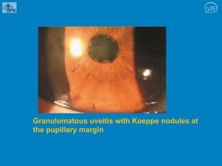 Koeppe Nodules