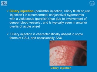 Uveitis signs and symptoms.pptx