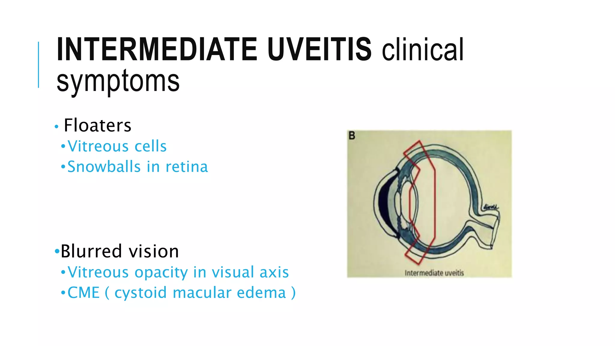 Uveitits classifications and Approach | PPTX