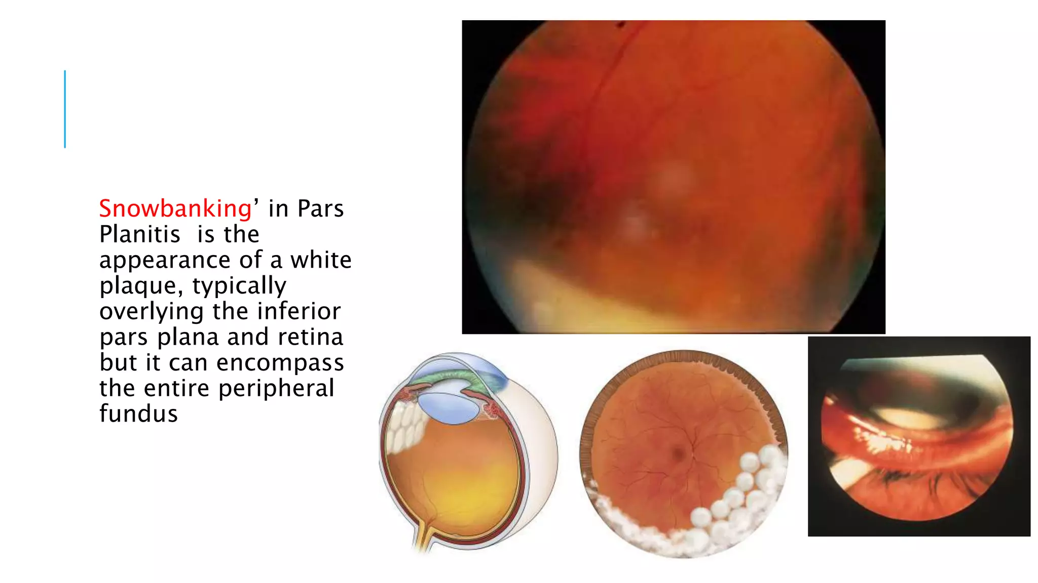Uveitits classifications and Approach | PPTX