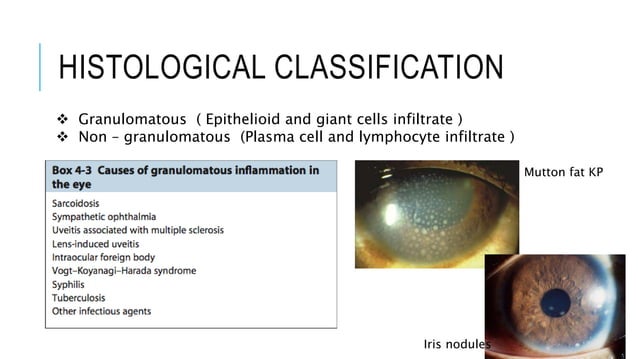 Uveitits classifications and Approach | PPTX | Eye and Vision ...