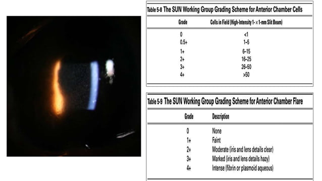 Uveitits classifications and Approach | PPTX | Eye and Vision ...