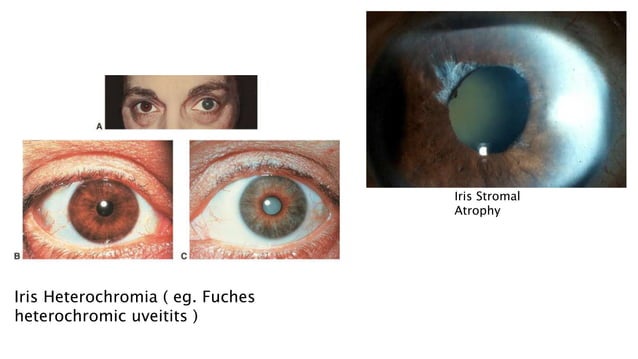 Uveitits classifications and Approach | PPTX | Eye and Vision Conditions | Diseases and Conditions