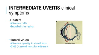 Uveitits classifications and Approach | PPTX