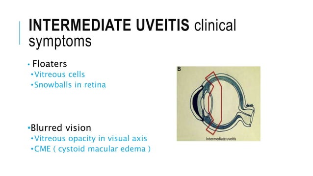 Uveitits classifications and Approach | PPTX | Eye and Vision ...