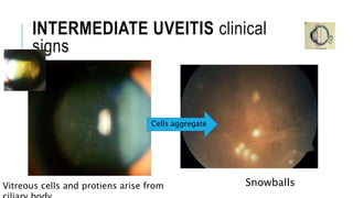 Uveitits classifications and Approach | PPTX