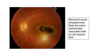 Uveitits classifications and Approach | PPTX