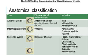 Uveitits classifications and Approach | PPTX