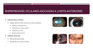 Uveítis | PDF