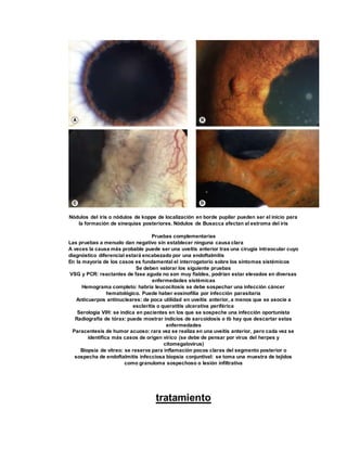 Uveítis anterior | DOCX