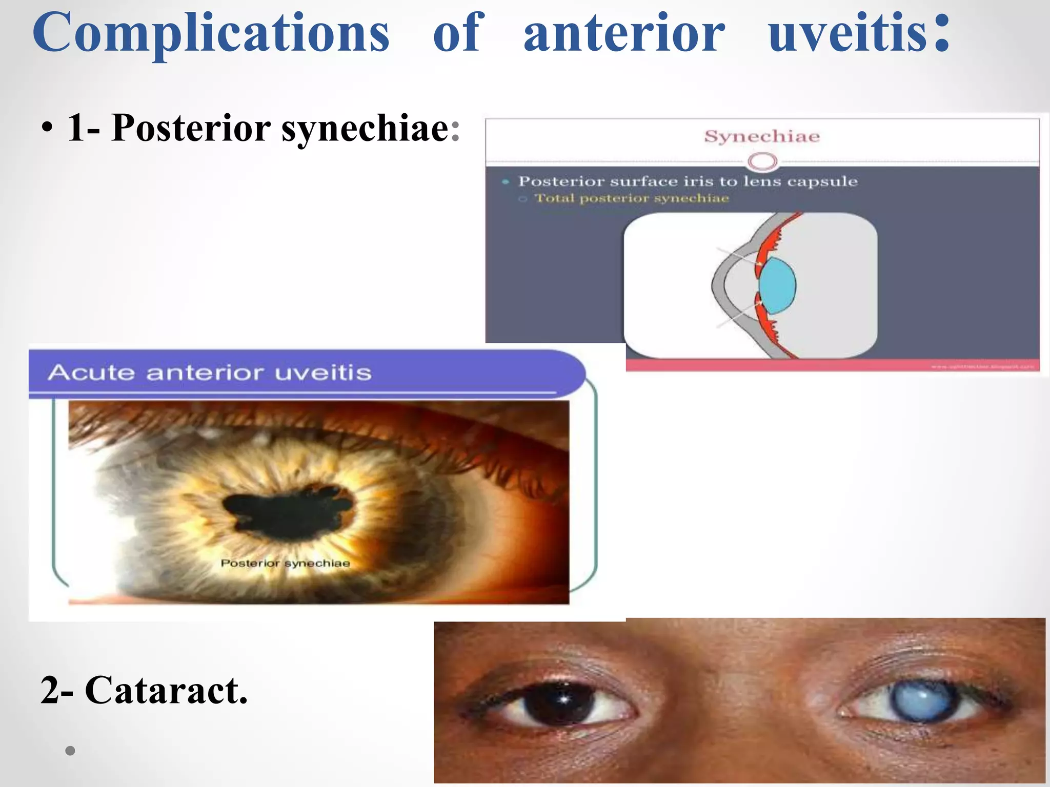 Uvitis/ opthalomology | PPTX