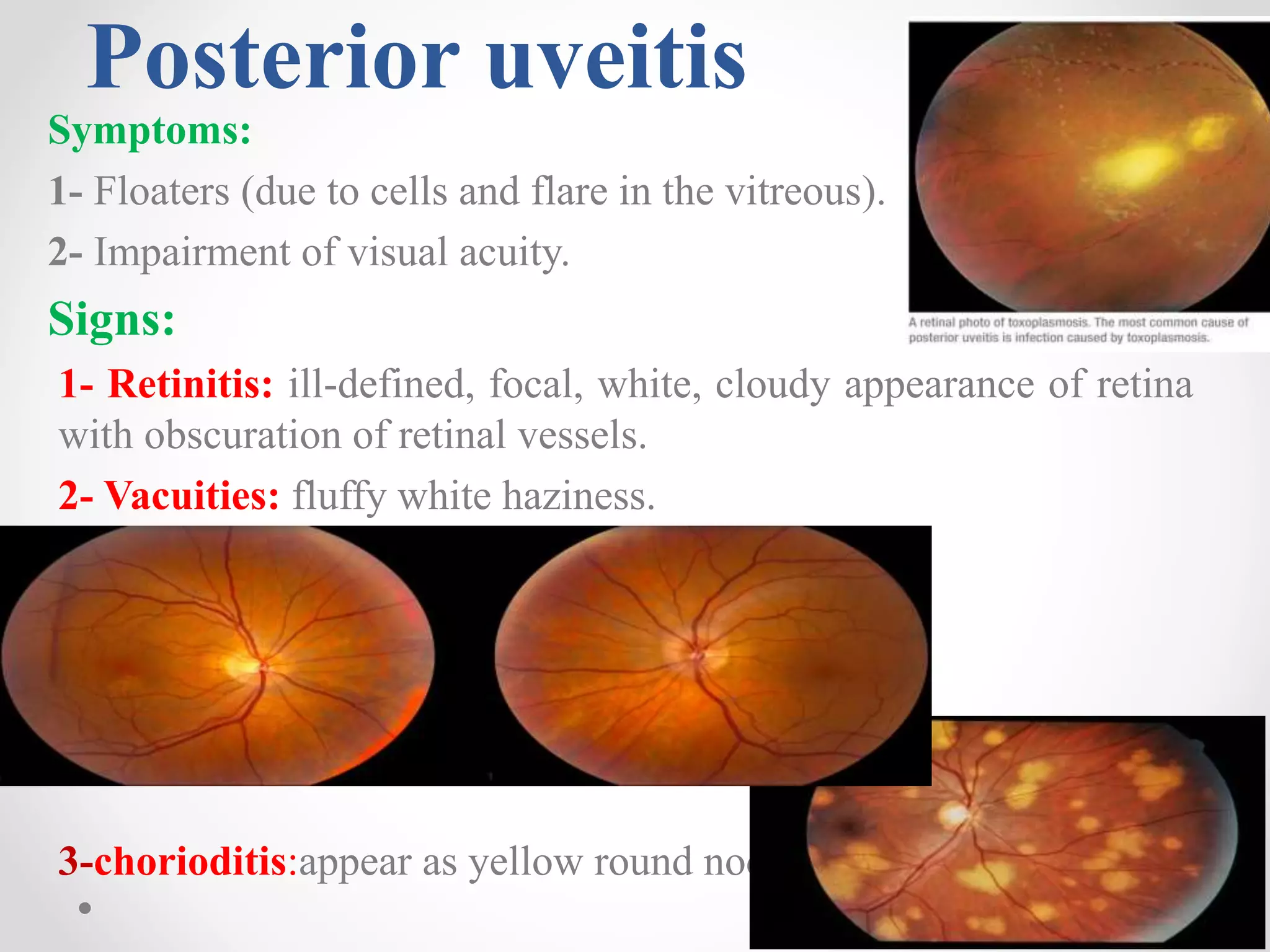 Uvitis/ opthalomology | PPT