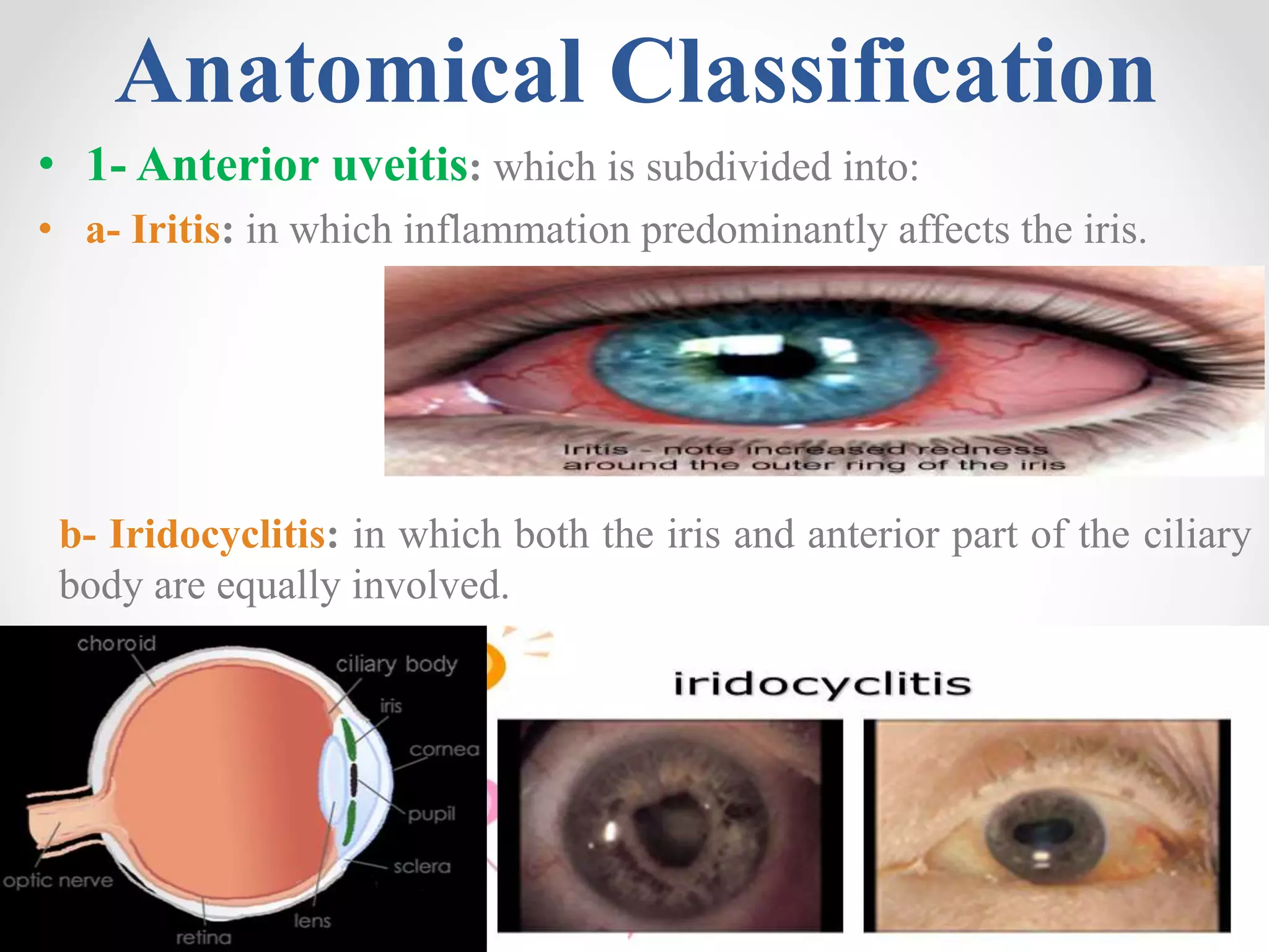 Uvitis/ opthalomology | PPTX