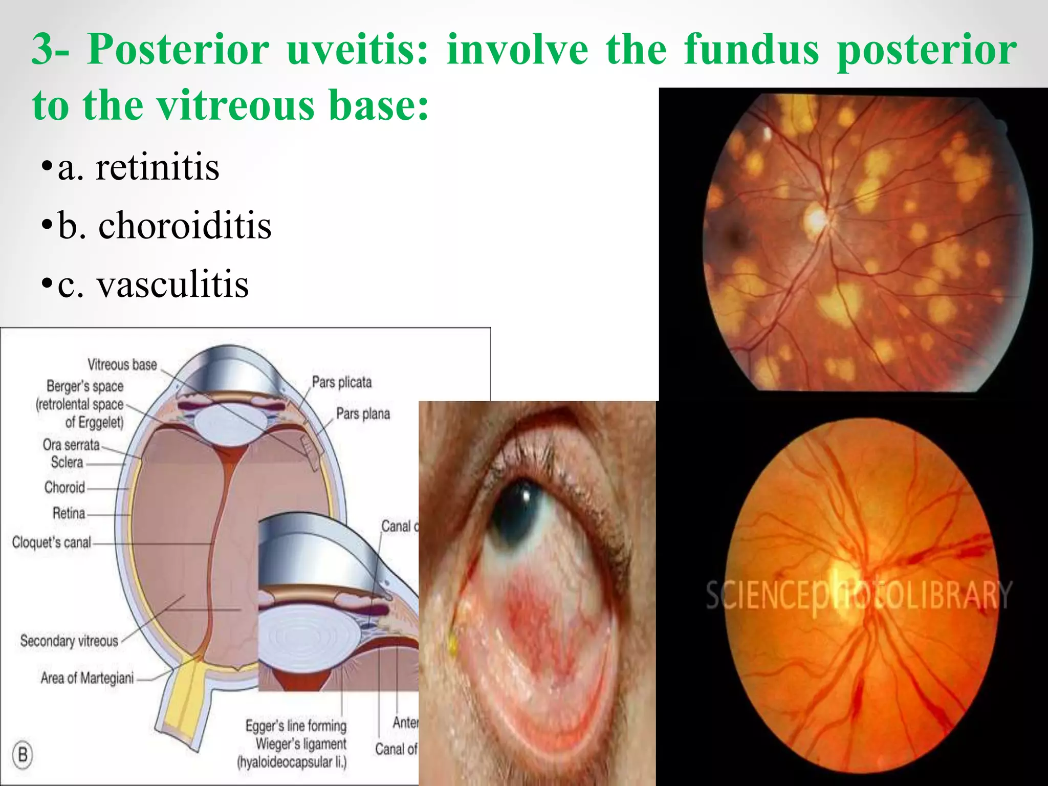 Uvitis/ opthalomology | PPT