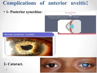 Uvitis/ opthalomology | PPT