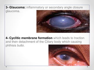 Uvitis/ opthalomology | PPT