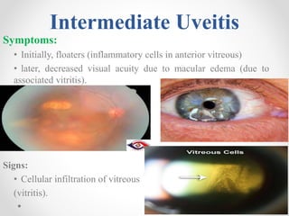Uvitis/ opthalomology | PPT