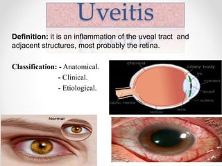 Uvitis/ opthalomology | PPT