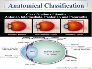 Uvitis/ opthalomology | PPT