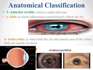 Uvitis/ opthalomology | PPT