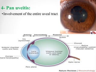 Uvitis/ opthalomology | PPT