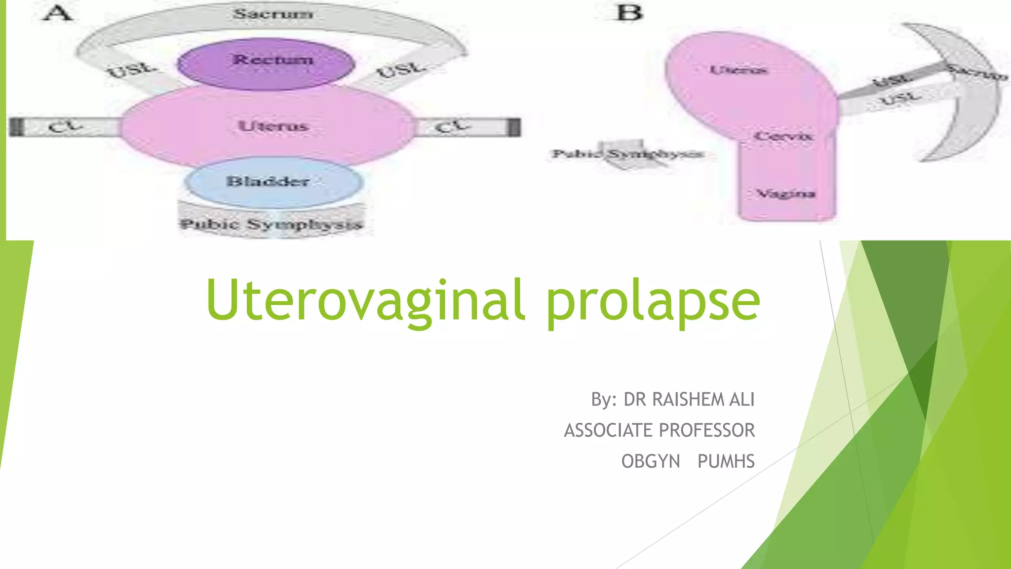 uv prolapse final.ppt