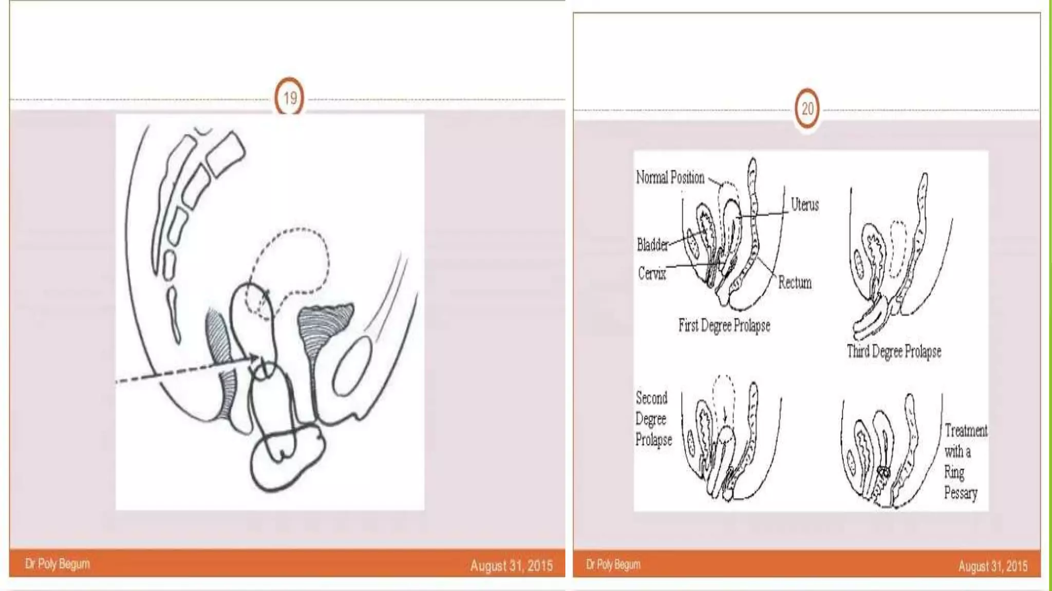 uv prolapse final.ppt