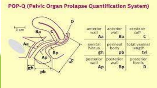 uv prolapse final.ppt