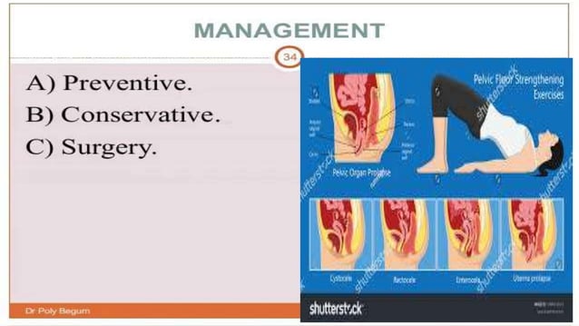 uv prolapse final.ppt