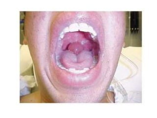 Uvular edema | PPT