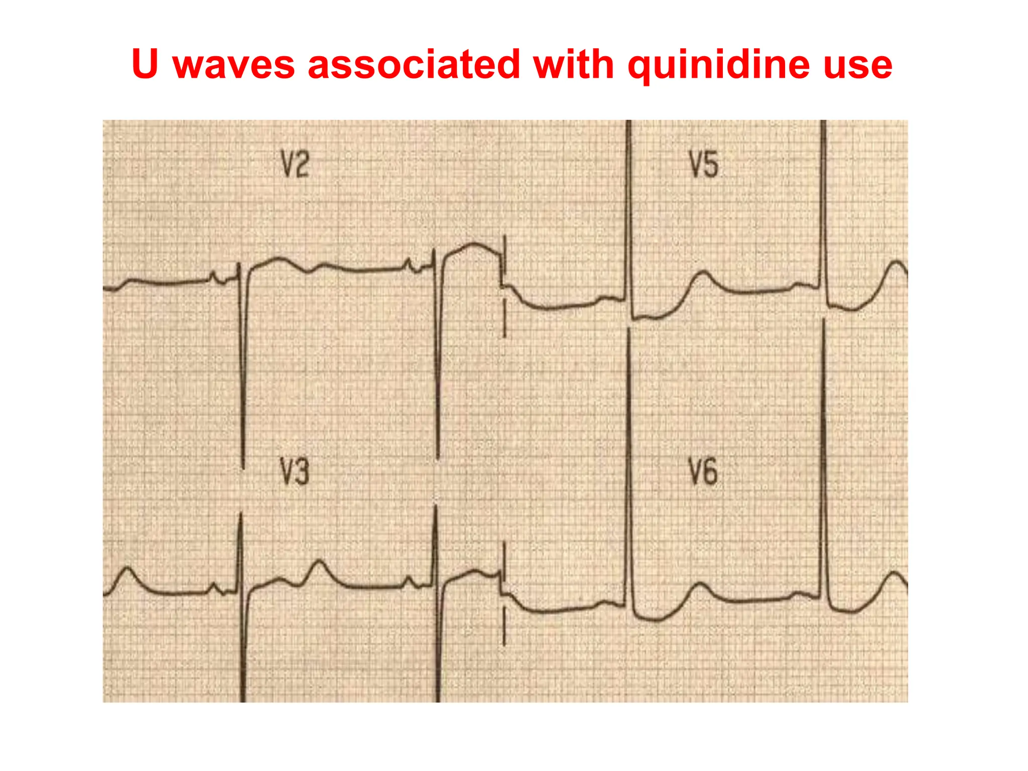 U WAVE IN ECG AND ITS ABNORMALITIES IN ECG | PPTX