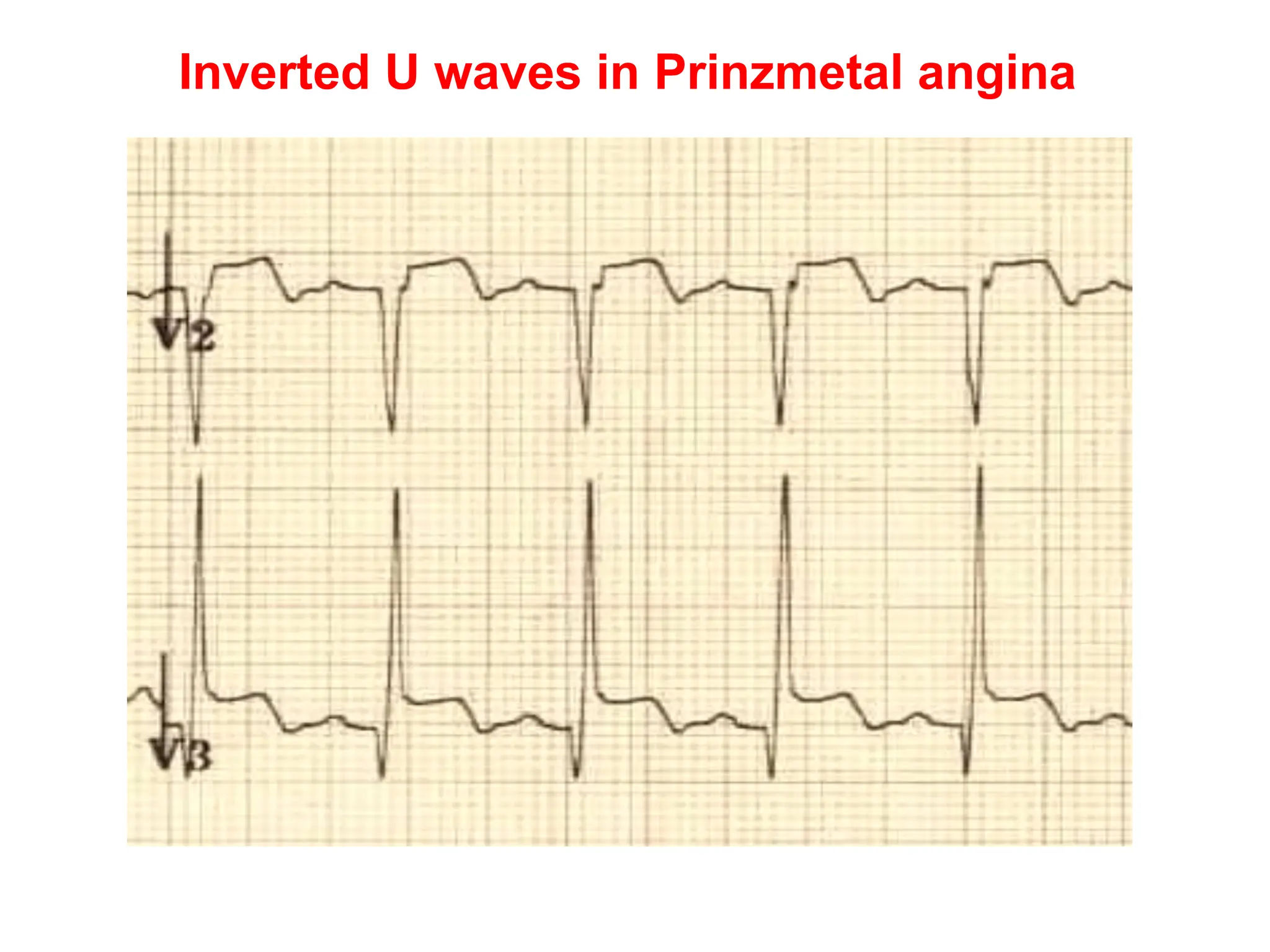 U WAVE IN ECG AND ITS ABNORMALITIES IN ECG | PPTX