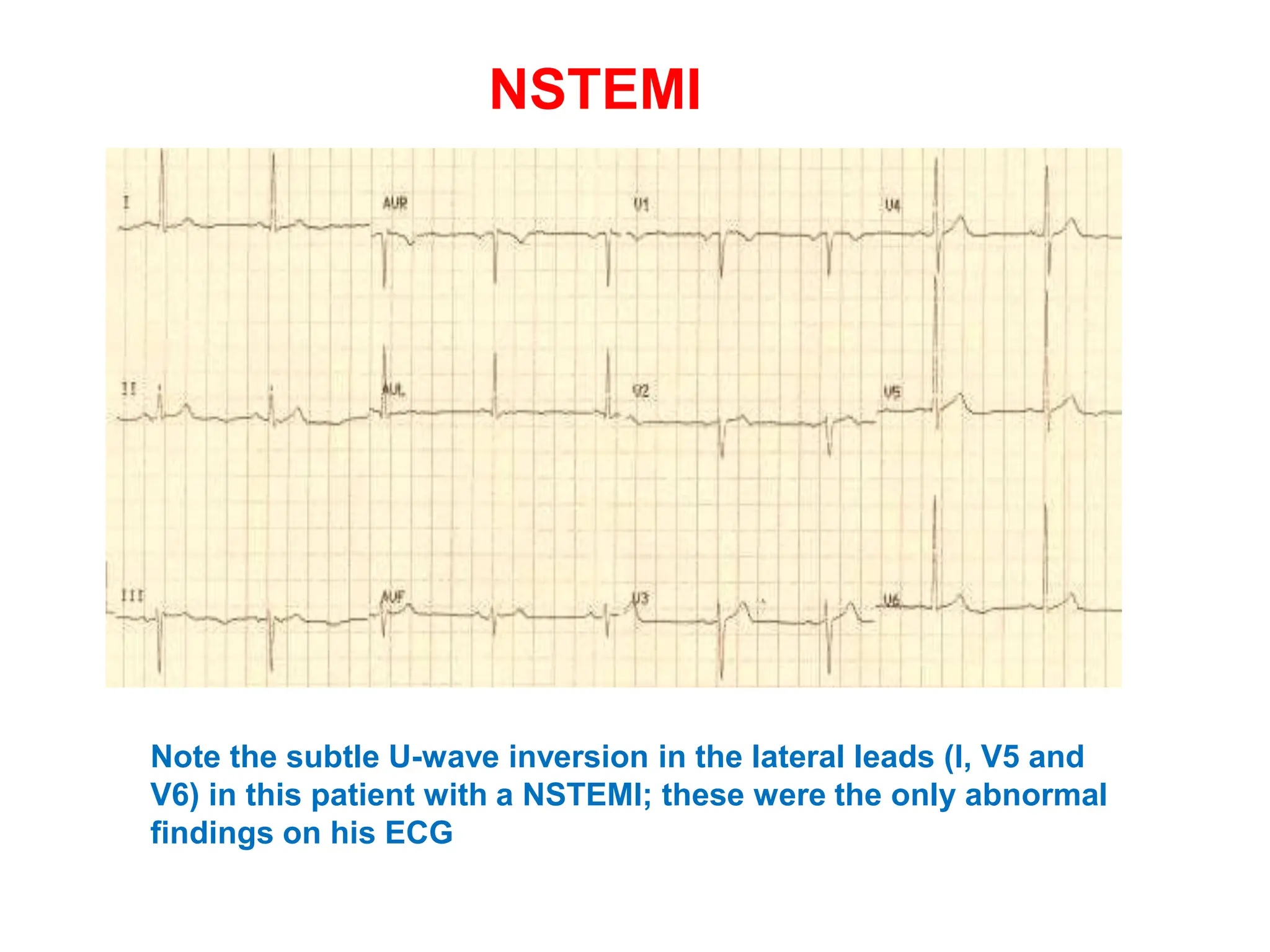 U WAVE IN ECG AND ITS ABNORMALITIES IN ECG | PPTX