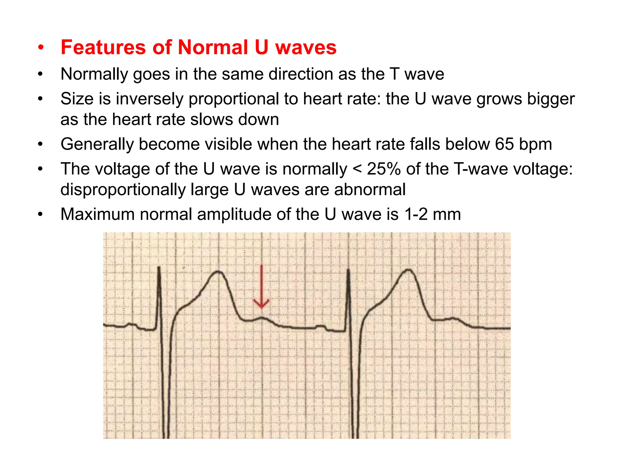 U WAVE IN ECG AND ITS ABNORMALITIES IN ECG | PPTX