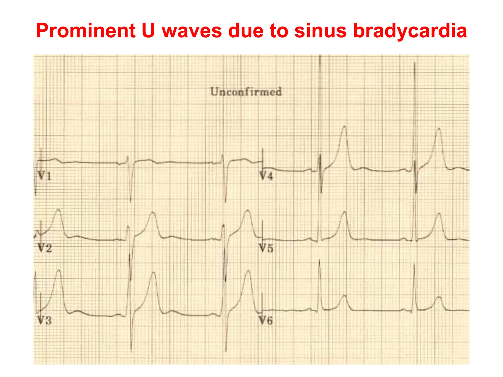 U WAVE IN ECG AND ITS ABNORMALITIES IN ECG | PPTX