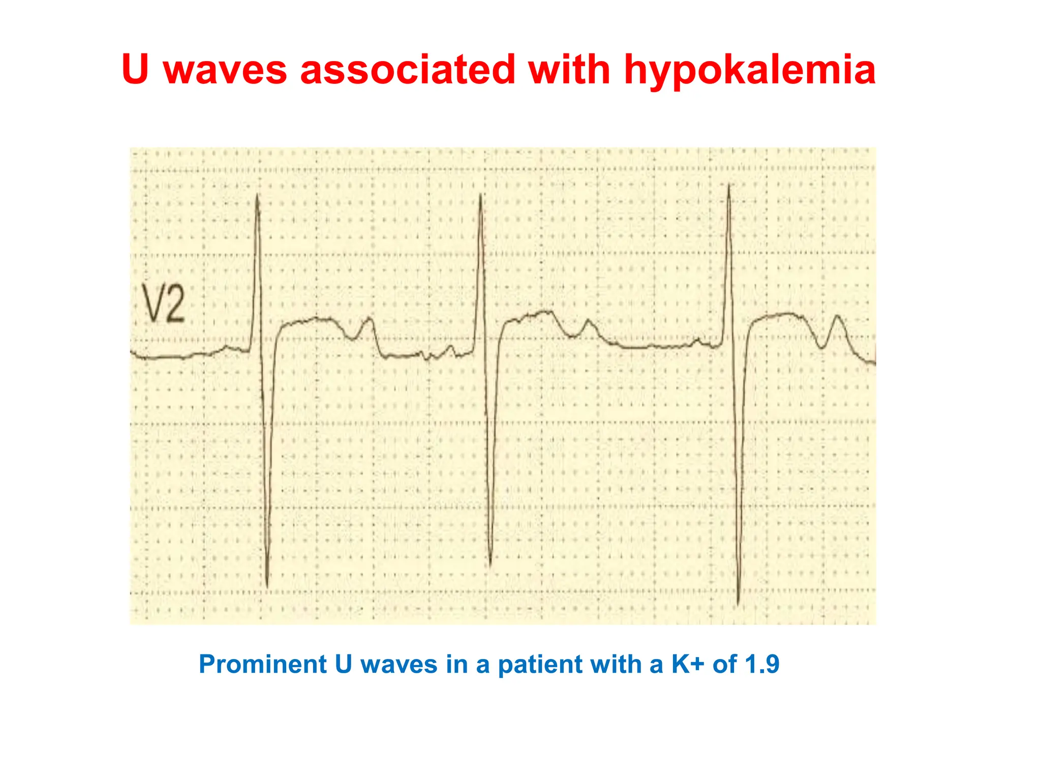 U WAVE IN ECG AND ITS ABNORMALITIES IN ECG | PPTX