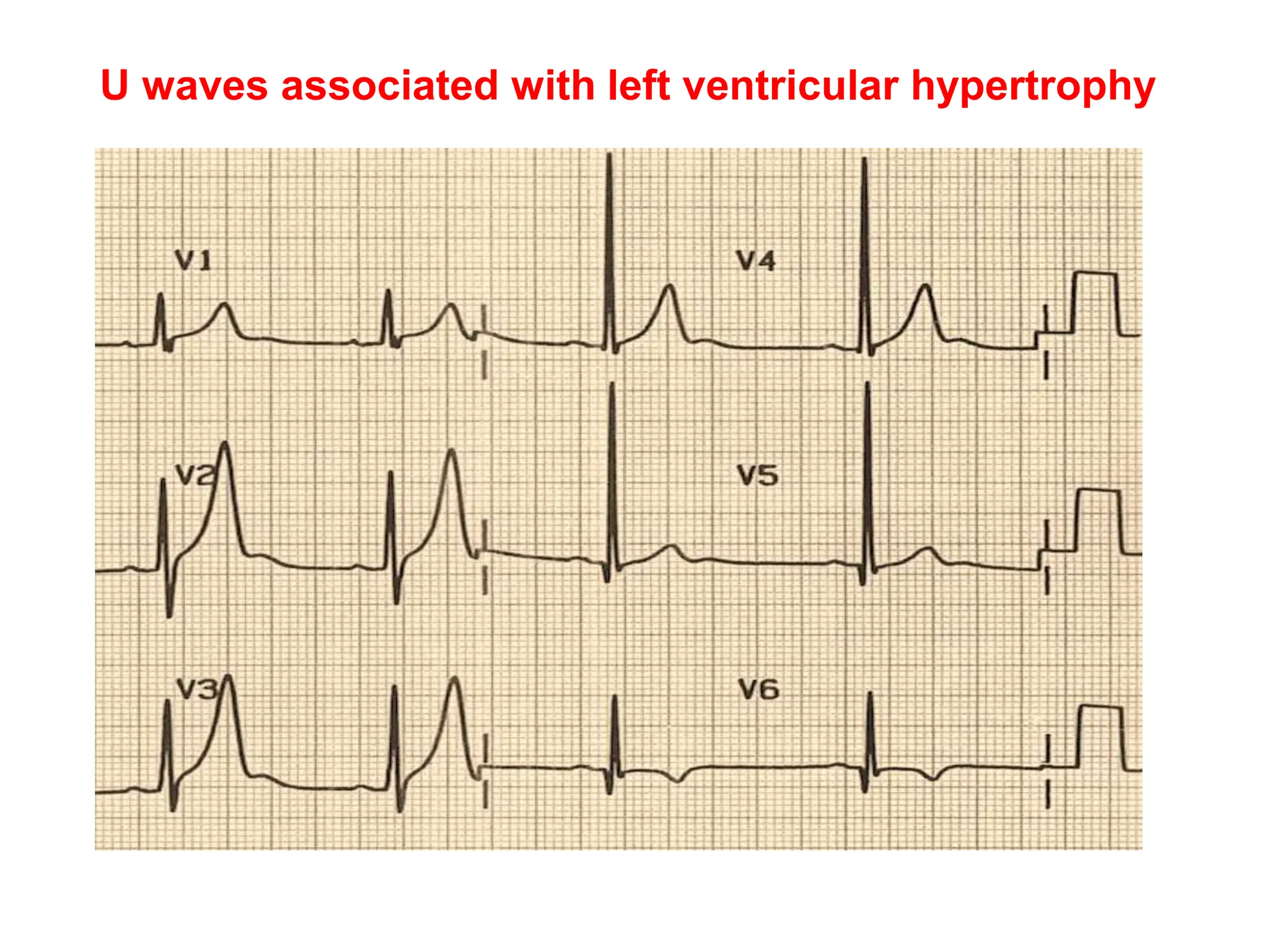 U WAVE IN ECG AND ITS ABNORMALITIES IN ECG PPTX U WAVE IN ECG AND ITS ABNORMALITIES IN ECG PPTX
