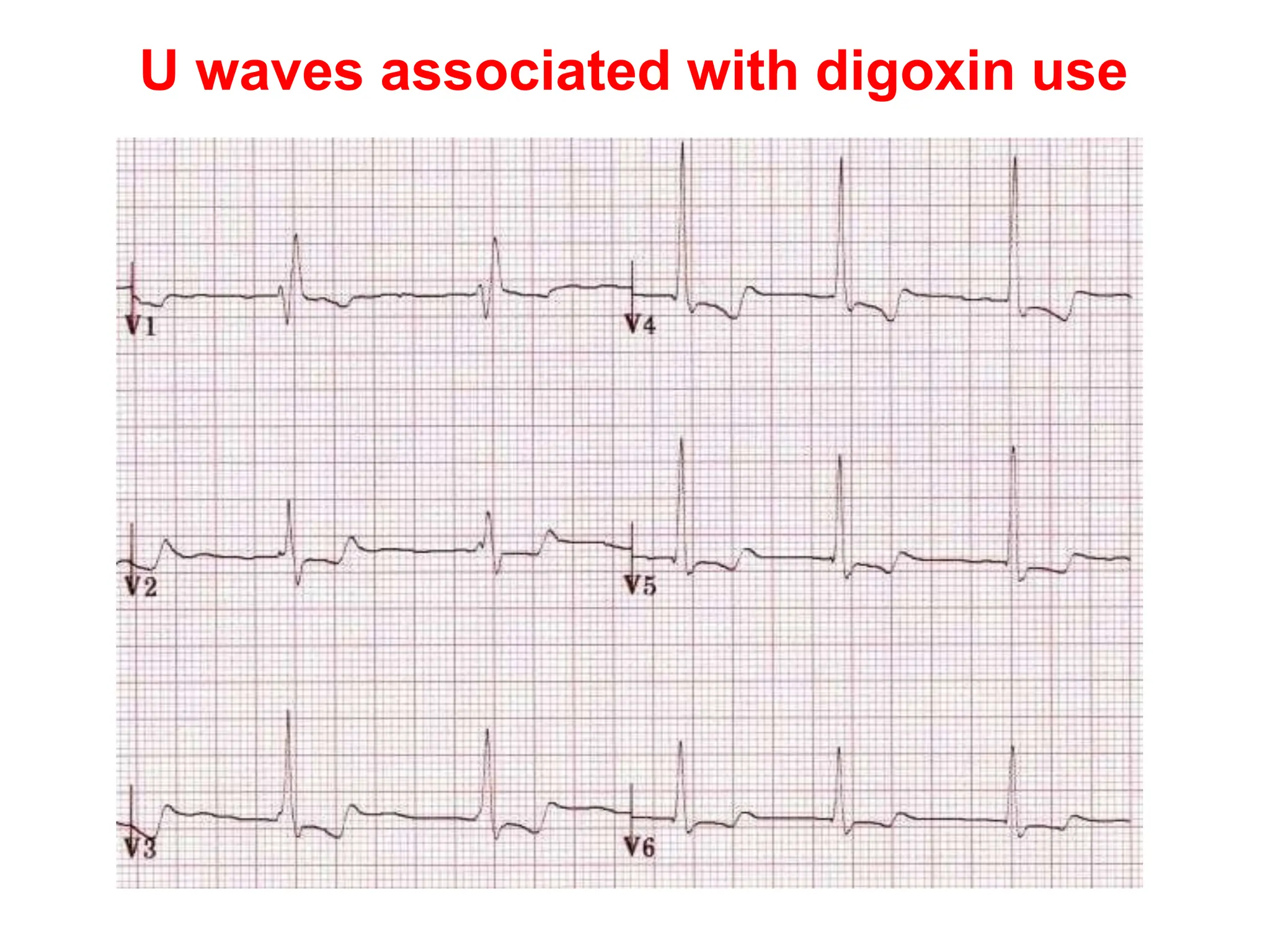 U WAVE IN ECG AND ITS ABNORMALITIES IN ECG | PPTX