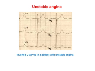 U WAVE IN ECG AND ITS ABNORMALITIES IN ECG | PPTX