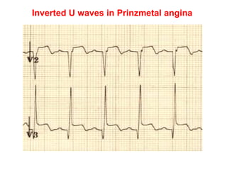 U WAVE IN ECG AND ITS ABNORMALITIES IN ECG | PPTX