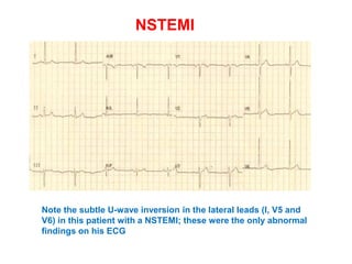 U WAVE IN ECG AND ITS ABNORMALITIES IN ECG | PPTX