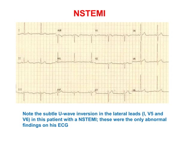 U WAVE IN ECG AND ITS ABNORMALITIES IN ECG | PPTX | Heart and ...