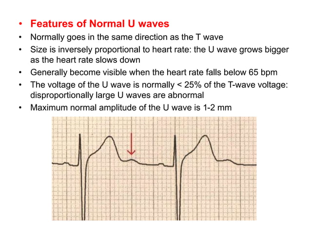 U WAVE IN ECG AND ITS ABNORMALITIES IN ECG | PPTX | Heart and ...
