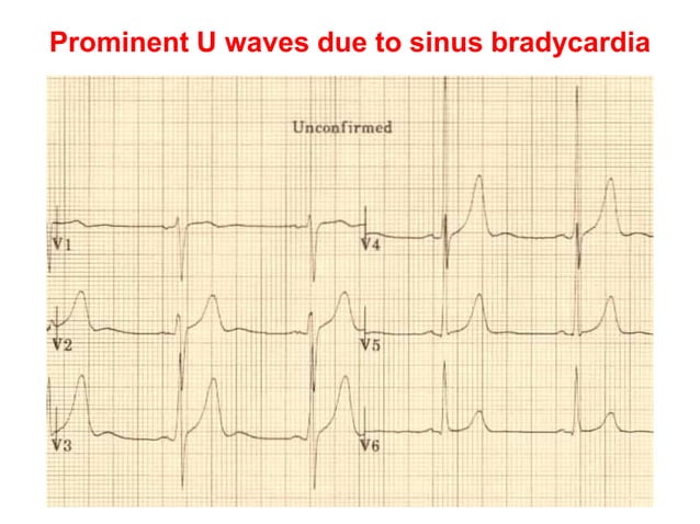 U WAVE IN ECG AND ITS ABNORMALITIES IN ECG | PPTX | Heart and ...
