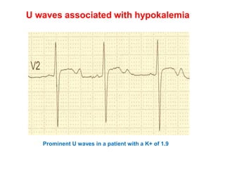 U WAVE IN ECG AND ITS ABNORMALITIES IN ECG | PPTX