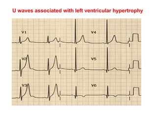 U WAVE IN ECG AND ITS ABNORMALITIES IN ECG | PPTX