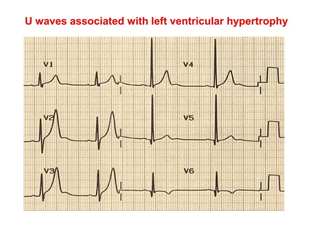 U WAVE IN ECG AND ITS ABNORMALITIES IN ECG | PPTX | Heart and ...